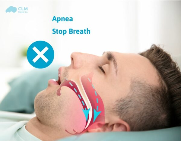 Apnea Meaning: Understanding the Causes, Types, and Treatments