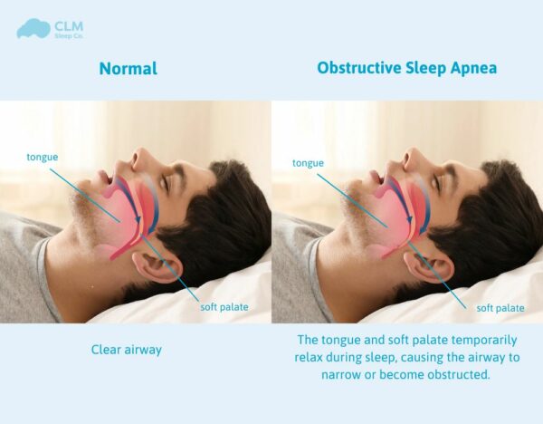 Obstructive Sleep Apnea (OSA): Symptoms, Cause, Treatment