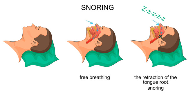 Top 12 Most Common Symptoms of Sleep Apnea in Australia