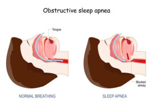Severe Sleep Apnea: Symptoms and Effective Treatment Options