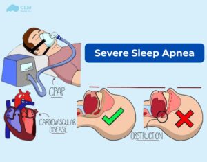 Severe Sleep Apnea: Symptoms and Effective Treatment Options