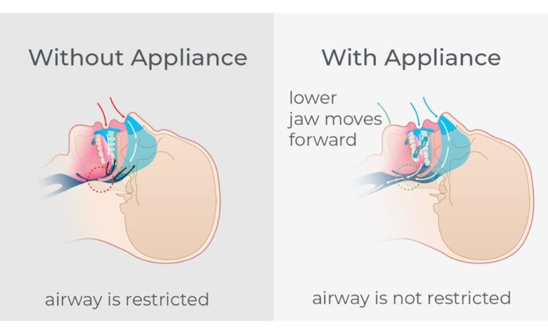 Sleep Apnea Mouth Guard: Effective Treatment for Better Sleep