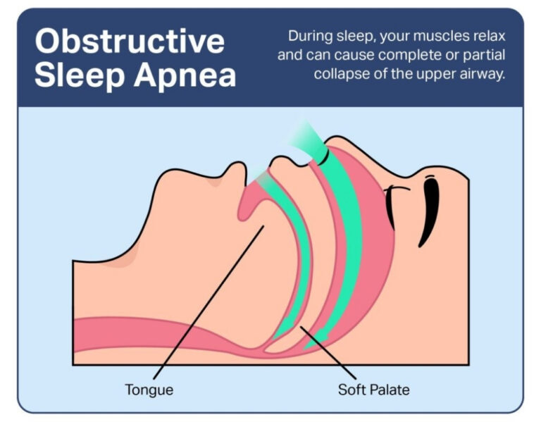 What Causes Sleep Apnea - Common Causes & Risk Factors Explained