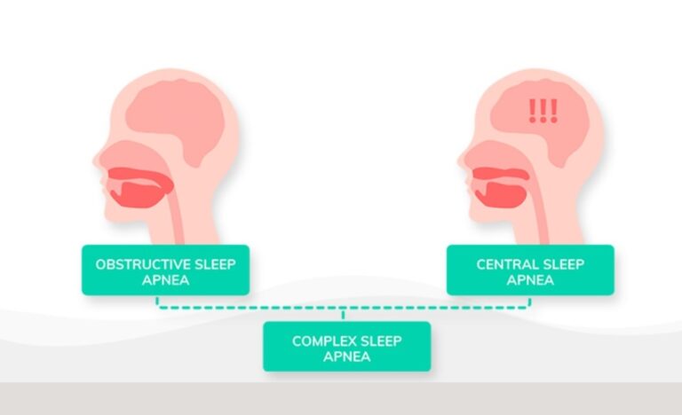 What Causes Sleep Apnea - Common Causes & Risk Factors Explained