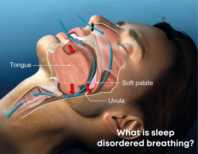 Sleep Disordered Breathing: Causes and Treatment Options