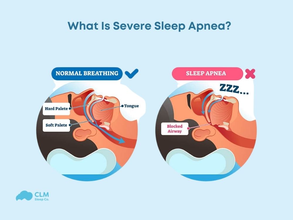 Top-Rated CPAP Machines for Severe Sleep Apnea