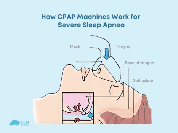 Top-Rated CPAP Machines for Severe Sleep Apnea